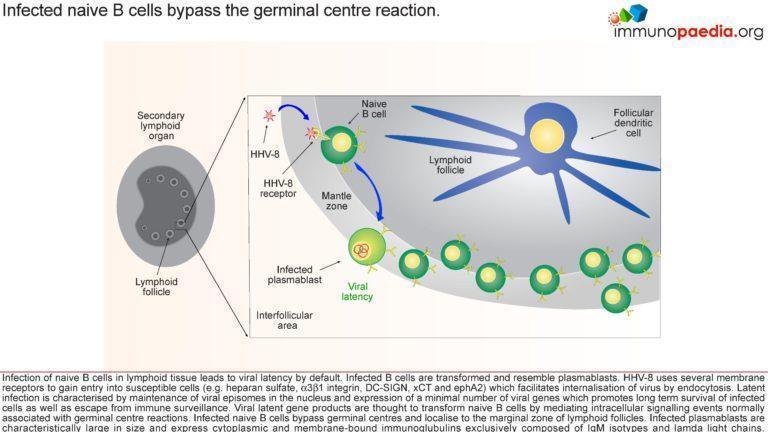 Multicentric Castleman’s disease Case Study | Immunopaedia