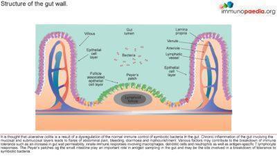 Ulcerative Colitis Case Study | Immunopaedia Immunopaedia