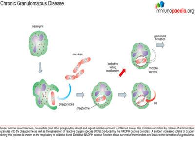 Chronic Granulomatous Disease Case Study | Immunopaedia