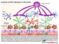 HIV associated dementia Case Study | Immunopaedia Immunopaedia