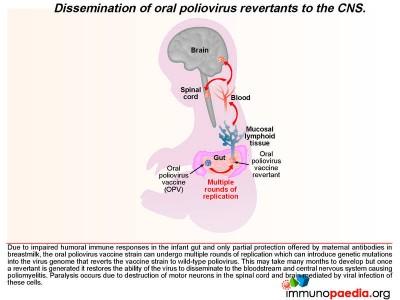 Vaccine Associated Paralytic Polio Case Study | Immunopaedia Immunopaedia