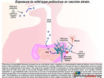 Vaccine Associated Paralytic Polio Case Study | Immunopaedia Immunopaedia