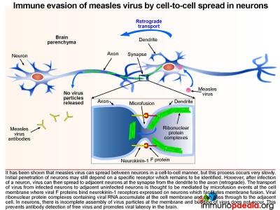 Subacute measles encephalitis Case Study | Immunopaedia