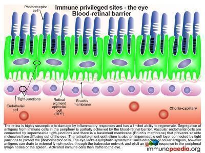 Sympathetic ophthalmia Case Study | Immunopaedia