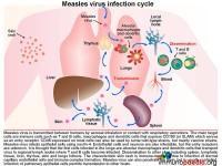 Subacute measles encephalitis Case Study | Immunopaedia