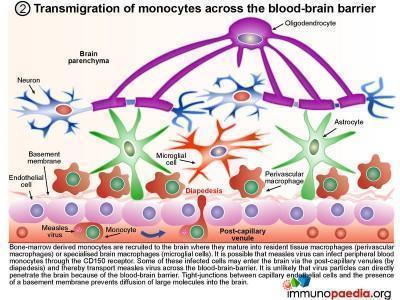 Subacute measles encephalitis Case Study | Immunopaedia