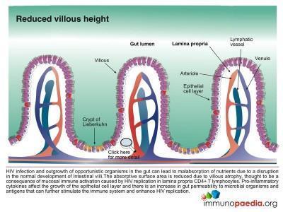 small-intestine-hiv-infection-figure1 | Immunopaedia