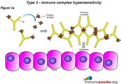 Arthus reaction Case Study | Immunopaedia