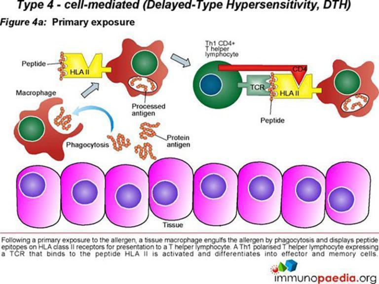 Arthus reaction Case Study | Immunopaedia Immunopaedia