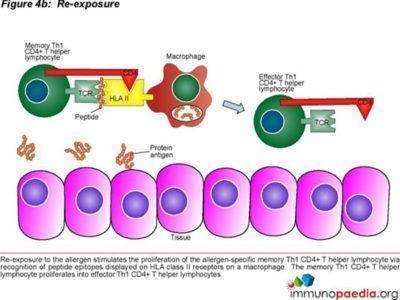 Arthus reaction Case Study | Immunopaedia Immunopaedia