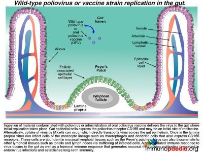 Vaccine Associated Paralytic Polio Case Study | Immunopaedia Immunopaedia