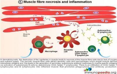 muscle-fibre-necrosis-and-inflammation | Immunopaedia Immunopaedia