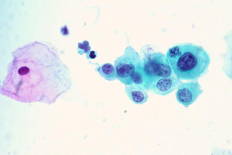 HPV E7 protein downregulates antitumour immunity | Immunopaedia