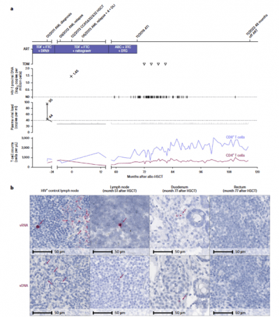 A potential cure for HIV may exist in stem cell transplantation ...