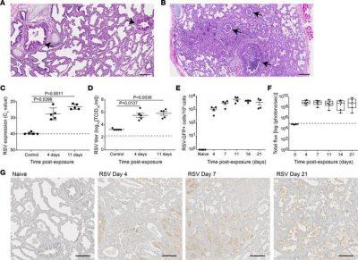 Respiratory Syncytial Virus (RSV) infection – the role of T cells ...