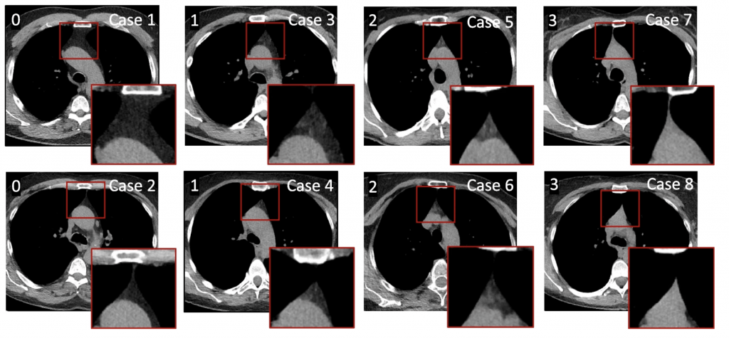 Unlocking the secrets of the thymus: a window into immune system aging ...