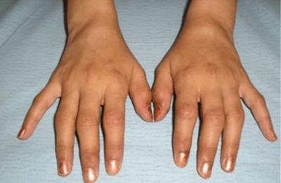 Rheumatoid arthritis (RA)| Immunopaedia