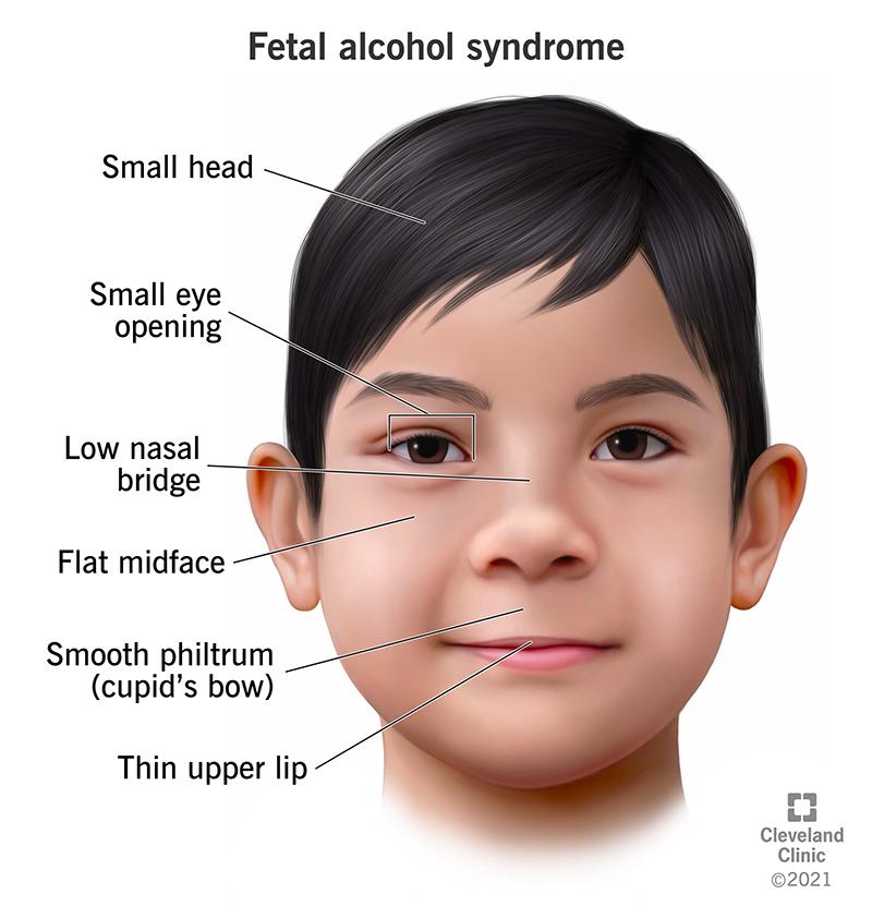 Fetal Alcohol Syndrome Logo