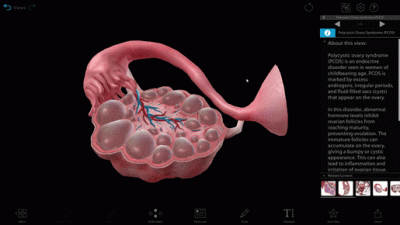 cysts-label-pcos | Immunopaedia