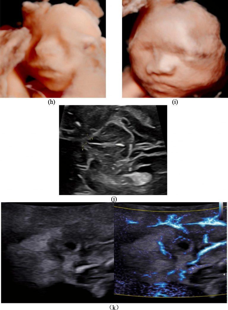 Prenatal Diagnosis of Ocular Malformations: Cryptophthalmos, Aphakia ...