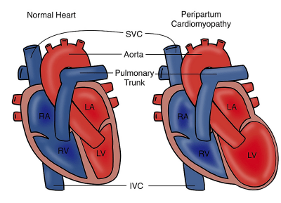 Peripartum Cardiomyopathy Understanding the Risks and Management ...